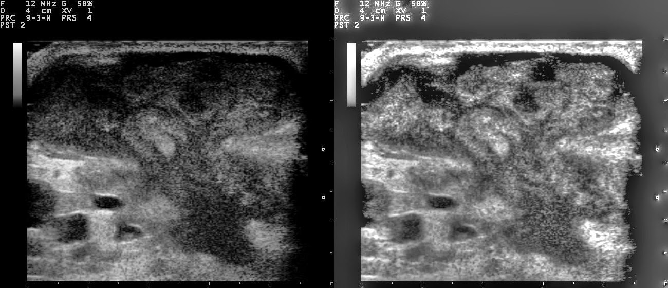 Nevit's blog: Ultrasound image of breast abscess. Original version and ...