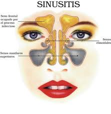 noelita: LA SINUSITIS Y SUS IMPLICACIONES DENTALES