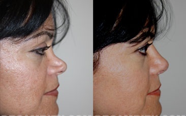 Hannan Medispa : nose bridge augmentation