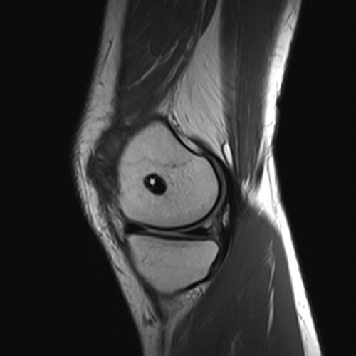 Running Solutions: Abnormal Knee MRI, But No Pain