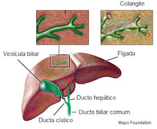 Blog Dr. Carlos: Colangites