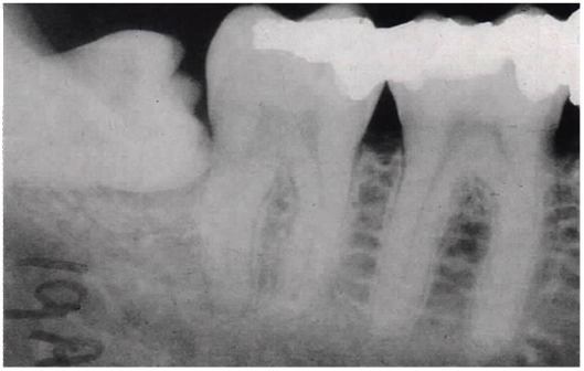 Dentistry and Medicine: Surgical management of Unerupted and Impacted teeth
