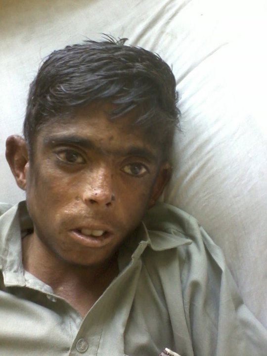 RARE THINGS SEEN IN MBBS - Congenital Erythropoietic Porphyria ...