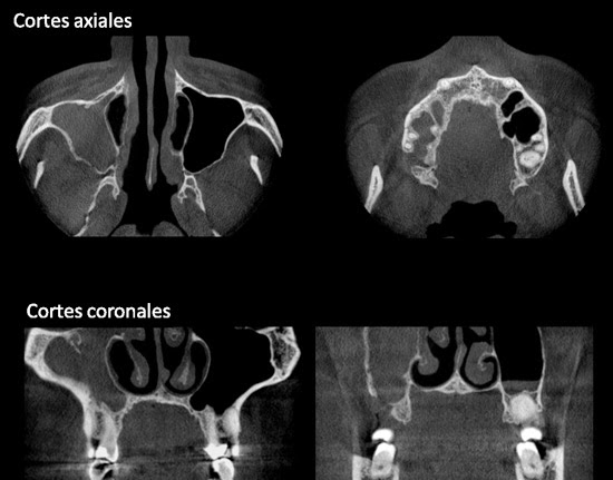 Exodoncia : COMPLICACIONES QUE SE PUEDEN PRESENTAR AL REALIZAR UNA ...