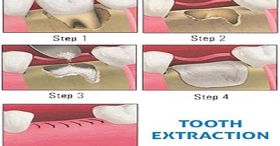 bridge dental : Simple and Surgical Extractions