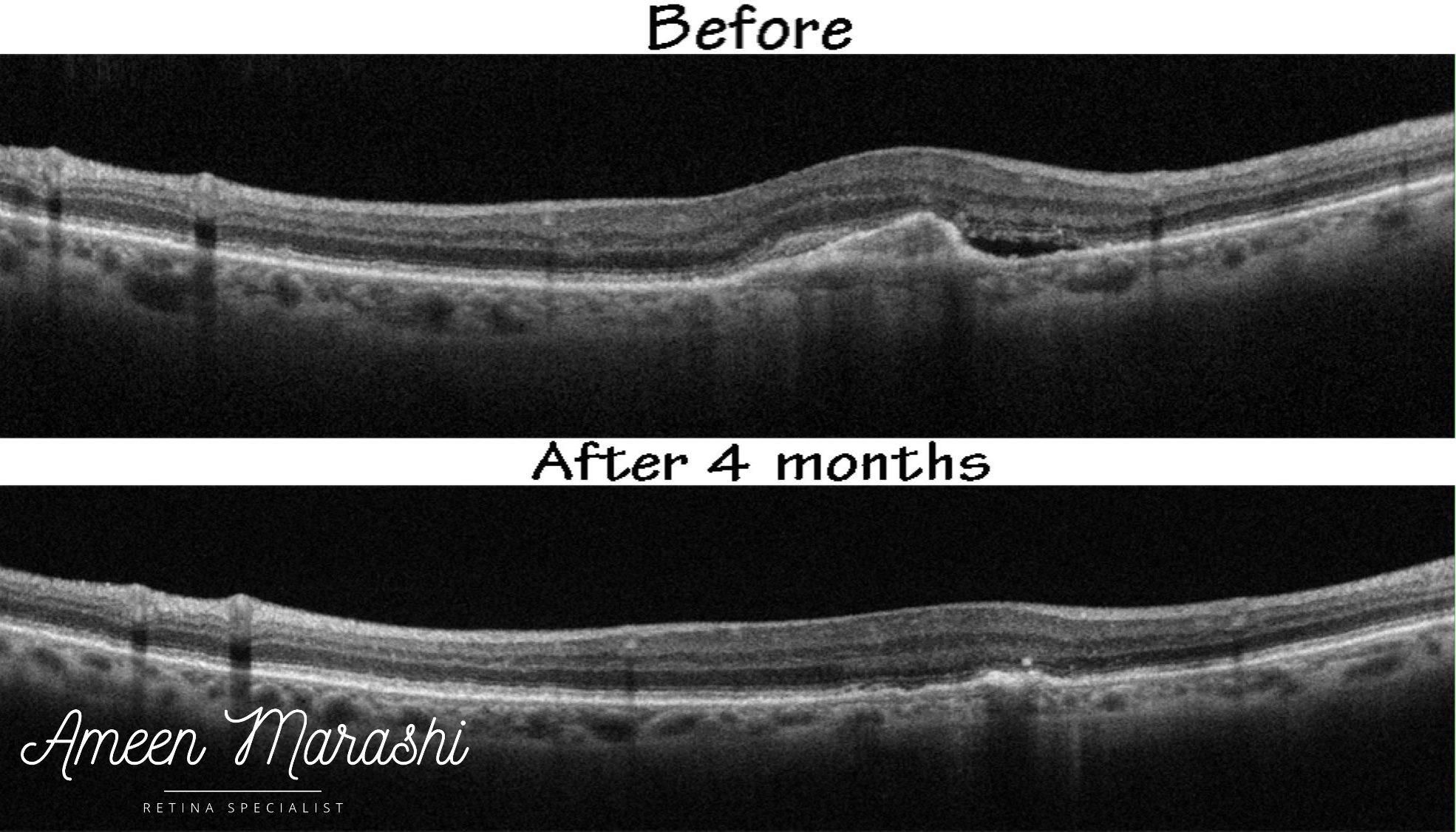 Fibrovascular PED Case report and Discussion
