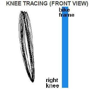 What Is A Capsular Pattern Of Restriction