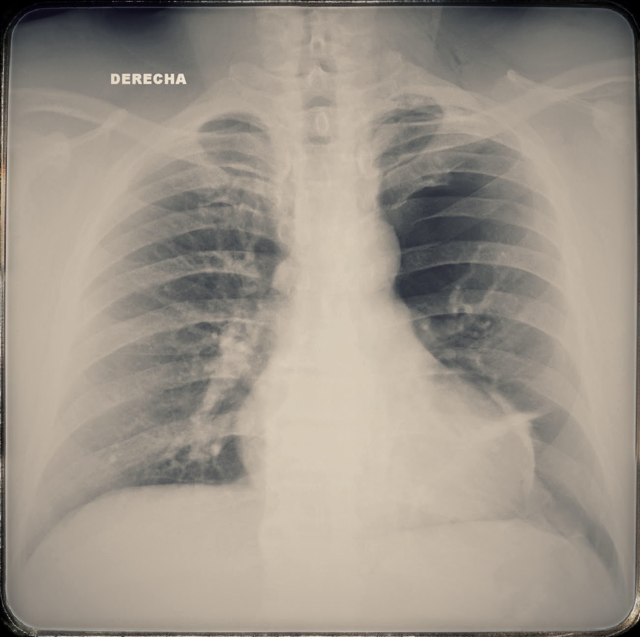 Radiologia Medica: Neumotórax por placa simple de tórax