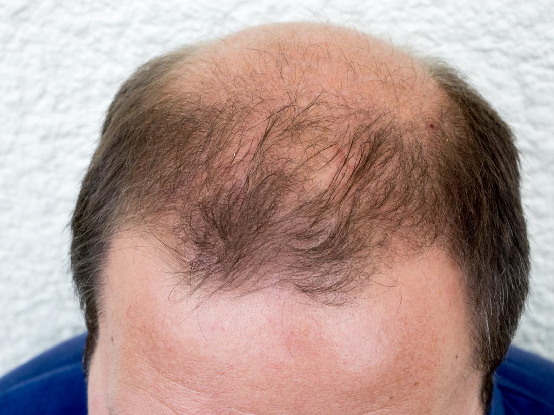 Tatizo La Kipara Kwa Vijana Androgenetic Alopecia Doctor Joh
