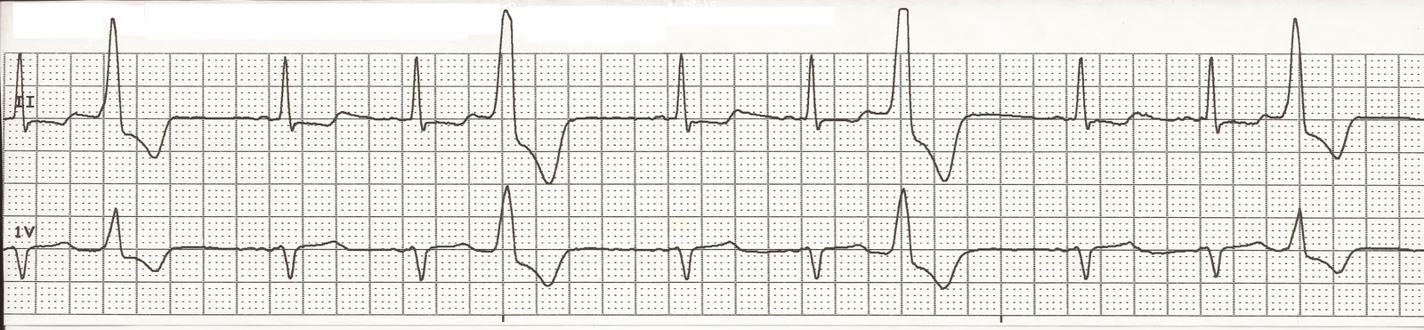 EKG Rhythm Strips: Bigeminy, Trigeminy, Quadrageminy