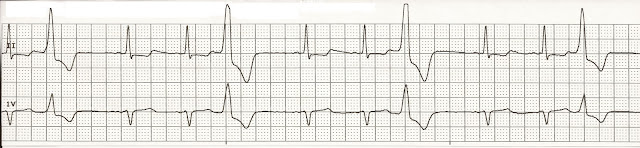 EKG Rhythm Strips: Bigeminy, Trigeminy, Quadrageminy