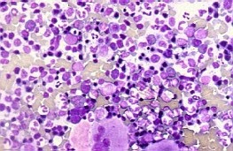 HEMATOLOGIA: POLICITEMIA VERA