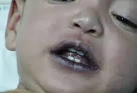 Ridiculously confortable : PERIPHERAL SIGNS