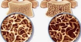 Porous bones - Definition and Treatment ~ Medical Health