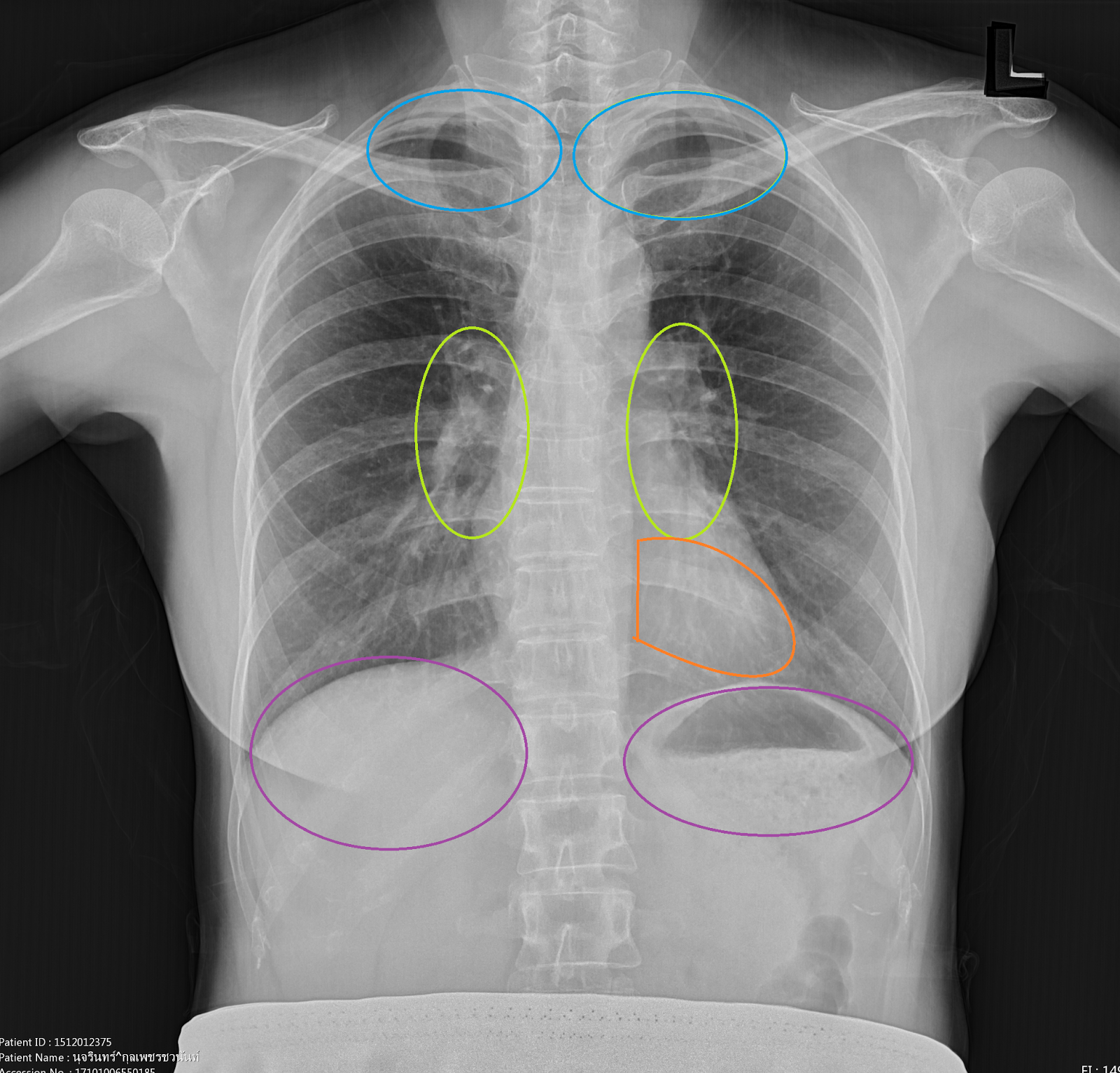 BRH-MICCAL-Learning: Hidden areas in chest radiograph