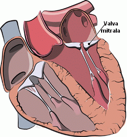 Alimentatie sanatoasa: Boli cardiovasculare - Insuficienta mitrala