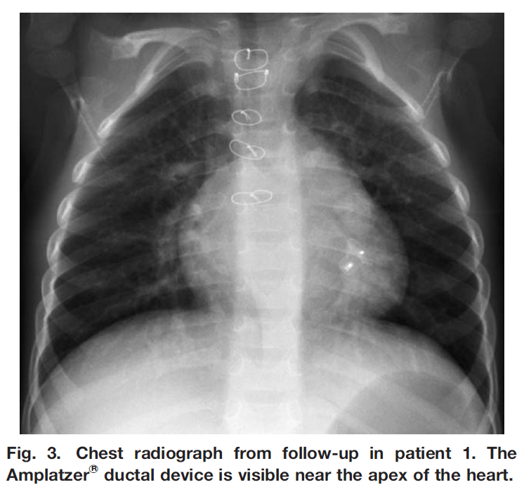Journal Club: Hybrid Procedure: Intraop. VSD closure