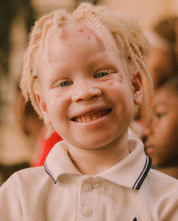 Freelance Content Writer at Work: Albino Children : Innocence Versus ...