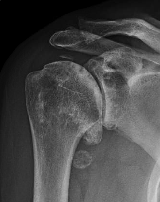 UW Shoulder and Elbow Academy: Ream and run for the retroverted glenoid ...