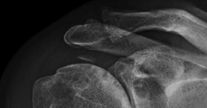 Shoulder Arthritis/Joint Replacement Rotator cuff tears: Ream and run ...