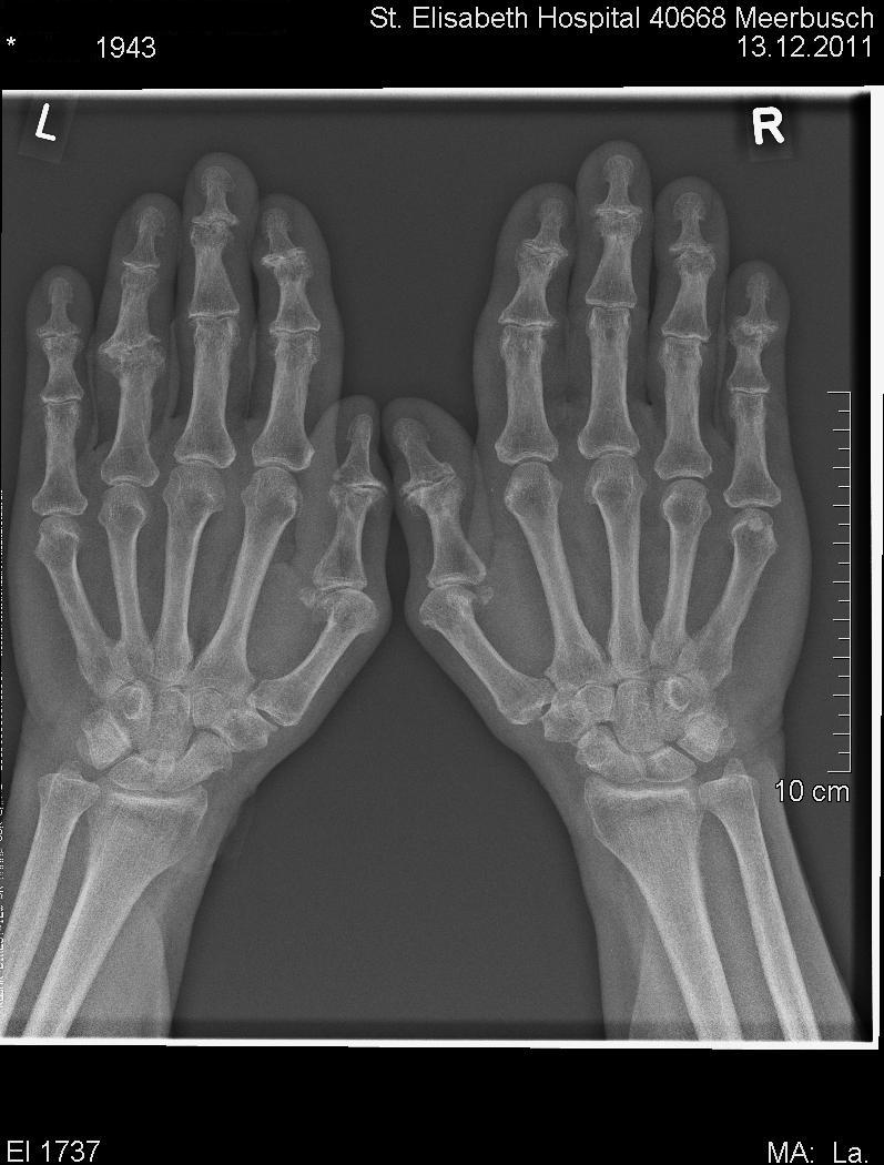 Rheumatologe: Arthrose Röntgenbilder der Hände - Osteoarthritis X-Rays ...