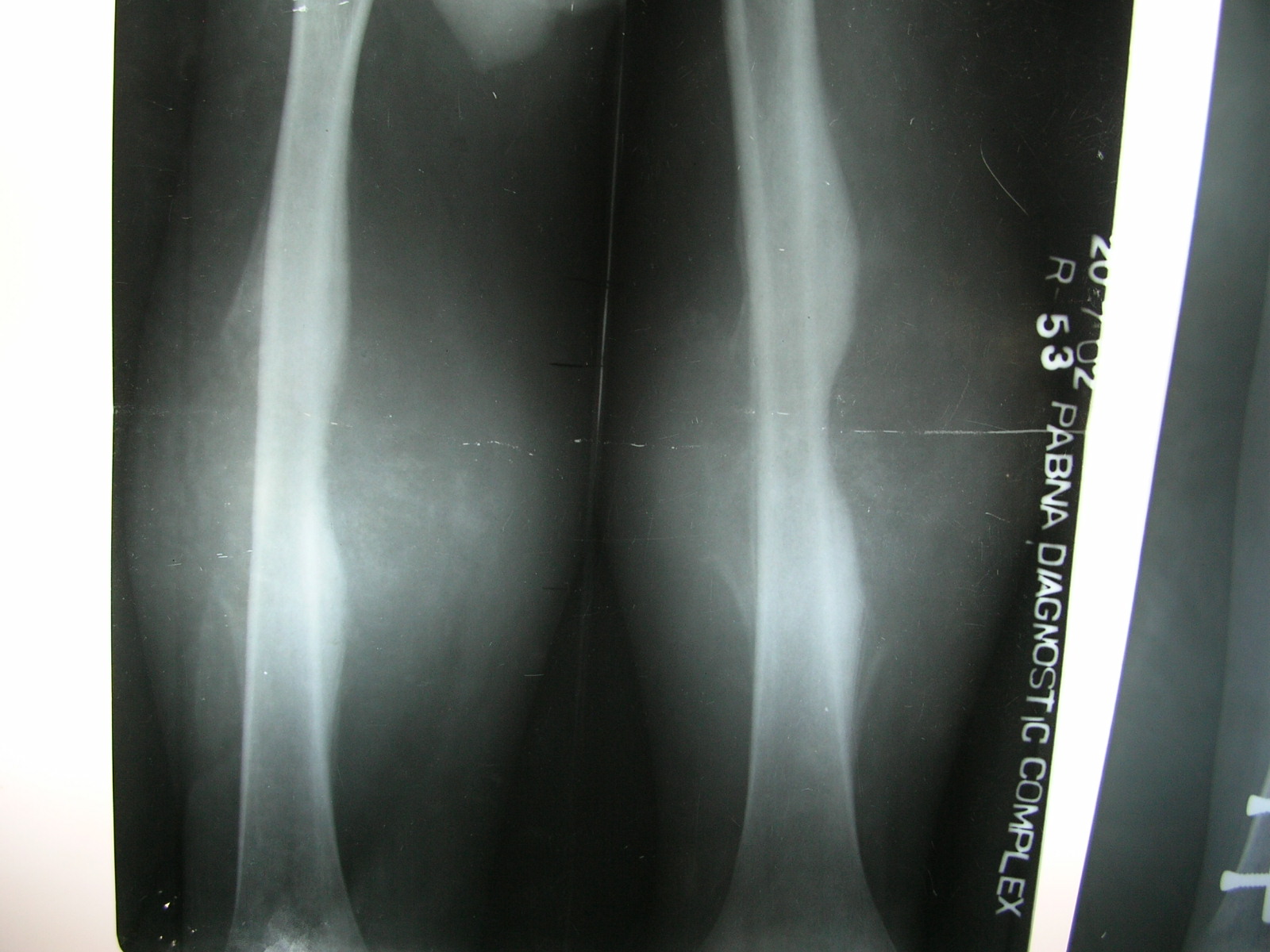 X-rays and Slides: Ewing's sarcoma of femur