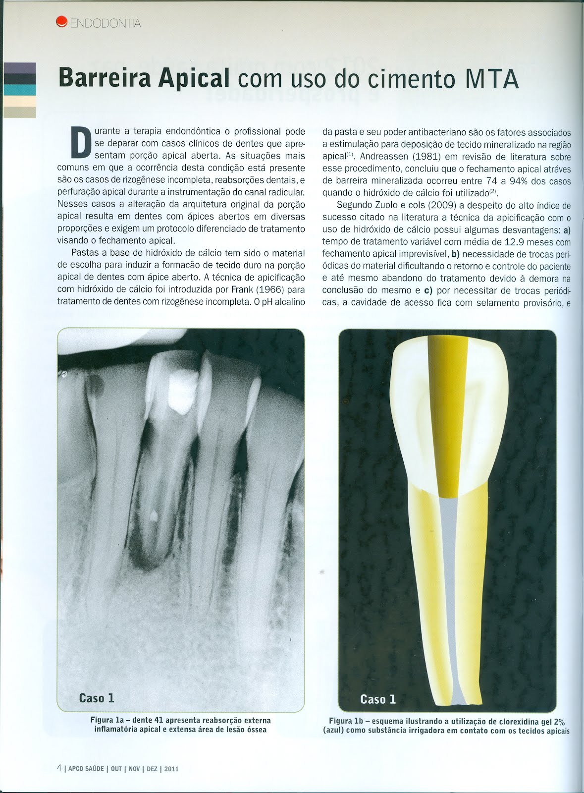 Blog do Endogroup: Plug apical de MTA - Endogroup