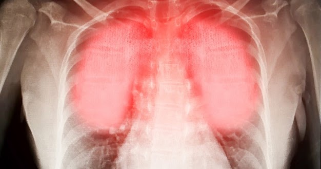 Sepideh Moayed on Blogger: ACR Backs Effort to Expand Lung Cancer ...