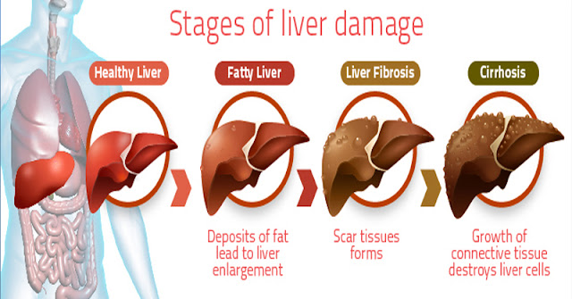 Watch Out for the Early Symptoms of Liver Damage