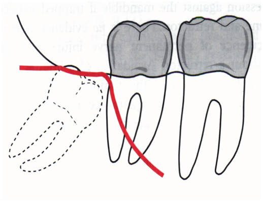 Dentistry and Medicine: Surgical management of Unerupted and Impacted teeth