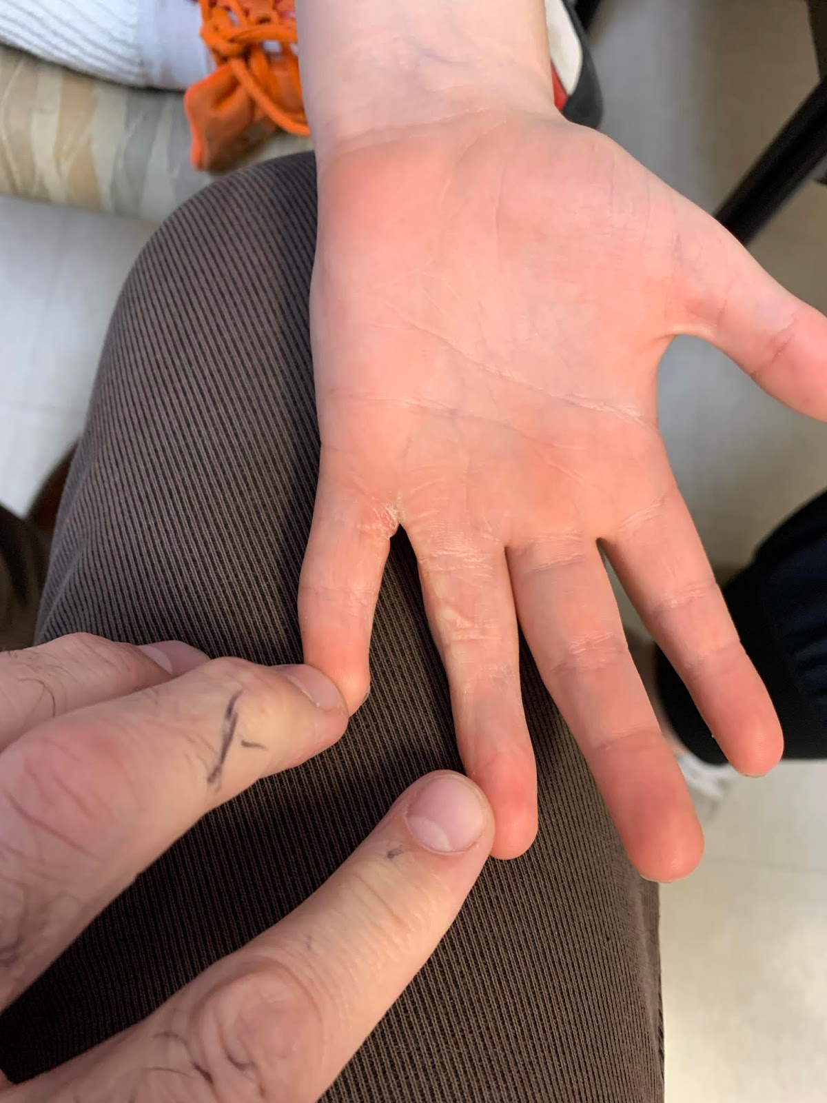 Recurrent Syndactyly | Congenital Hand and Arm Differences | Washington ...