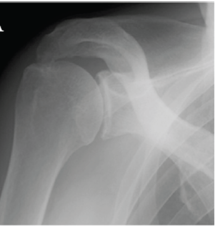 Shoulder Arthritis / Joint Replacement : Superior capsular ...