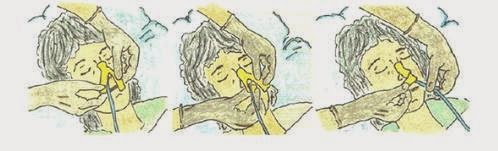 2014-emq1-ab-2: PRACTICA 3 - SONDA NASOGASTRICA