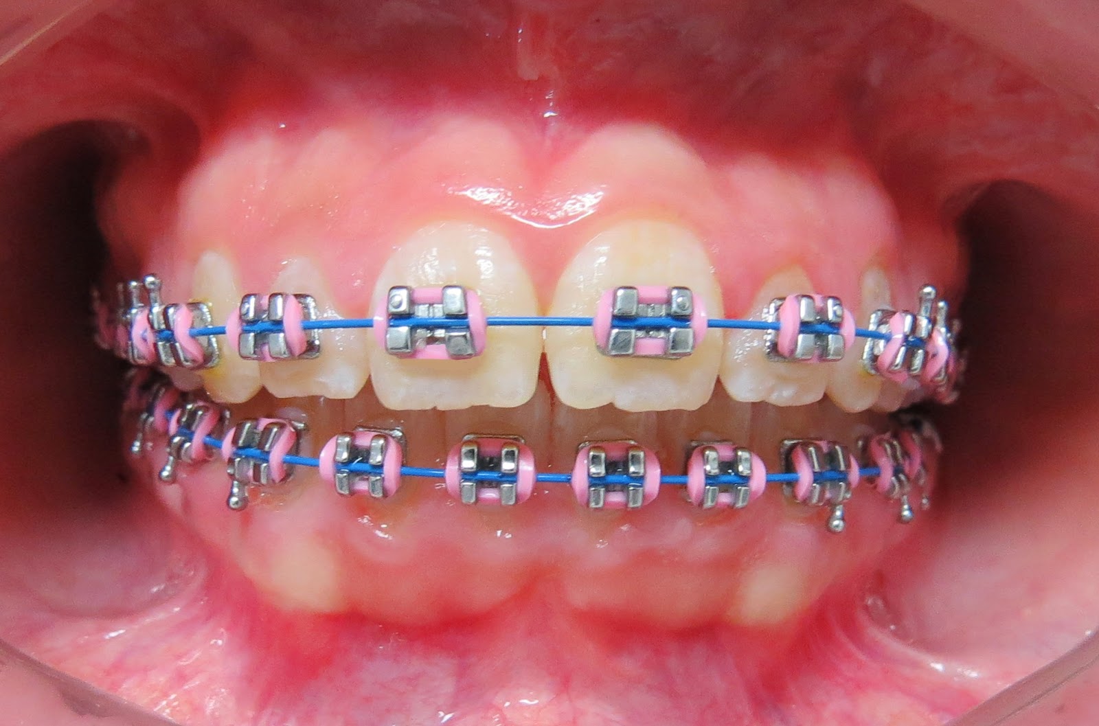 Ortodontia.com.Borel: Aparelho Estético ou Metálico? (Tipos de Aparelhos)