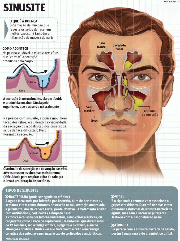 Divina Profissão: Sinusite