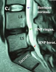 Corner Radiologi: HERNIA NUKLEUS PULPOSUS
