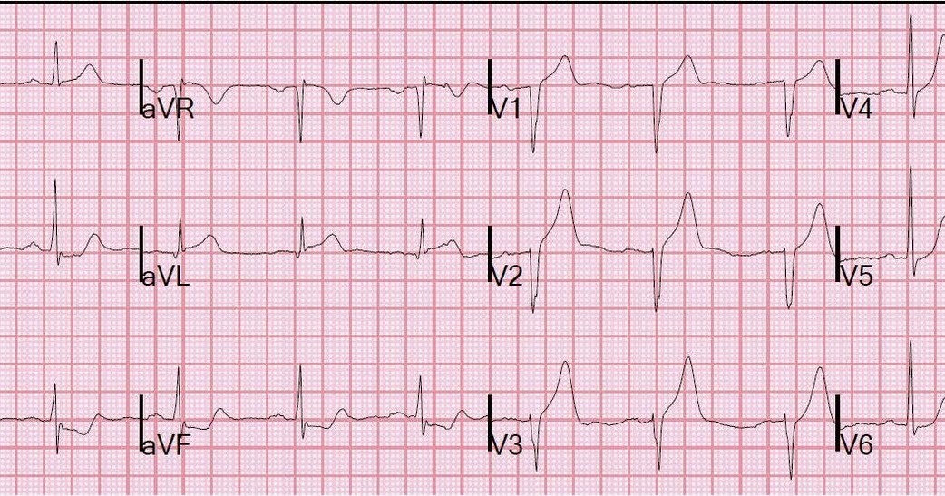 Dr. Smith's ECG Blog: Hyperacute T-waves, missed by computer, short DBT ...