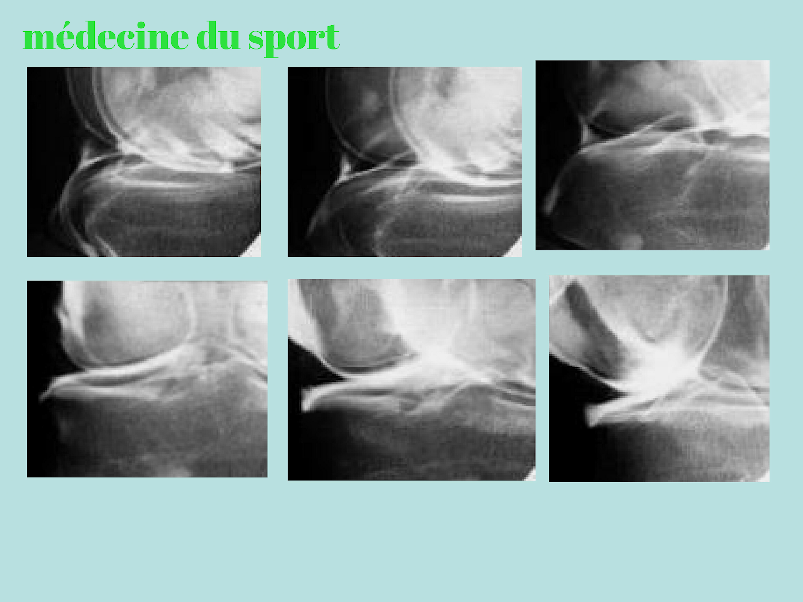 IMAGERIE DU GENOU APPLIQUÉE A LA PATHOLOGIE SPORTIVE
