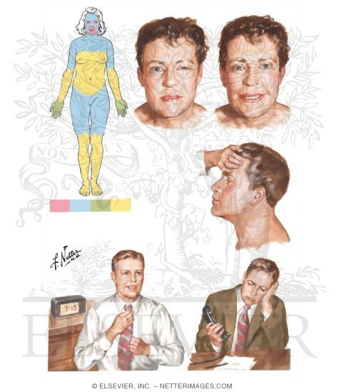 Signs and Symptoms Of Myasthenia Gravis |Genetic Engineering Info