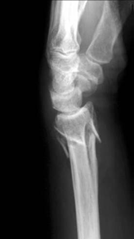 ABC Radiology Blog: Colles’ fracture