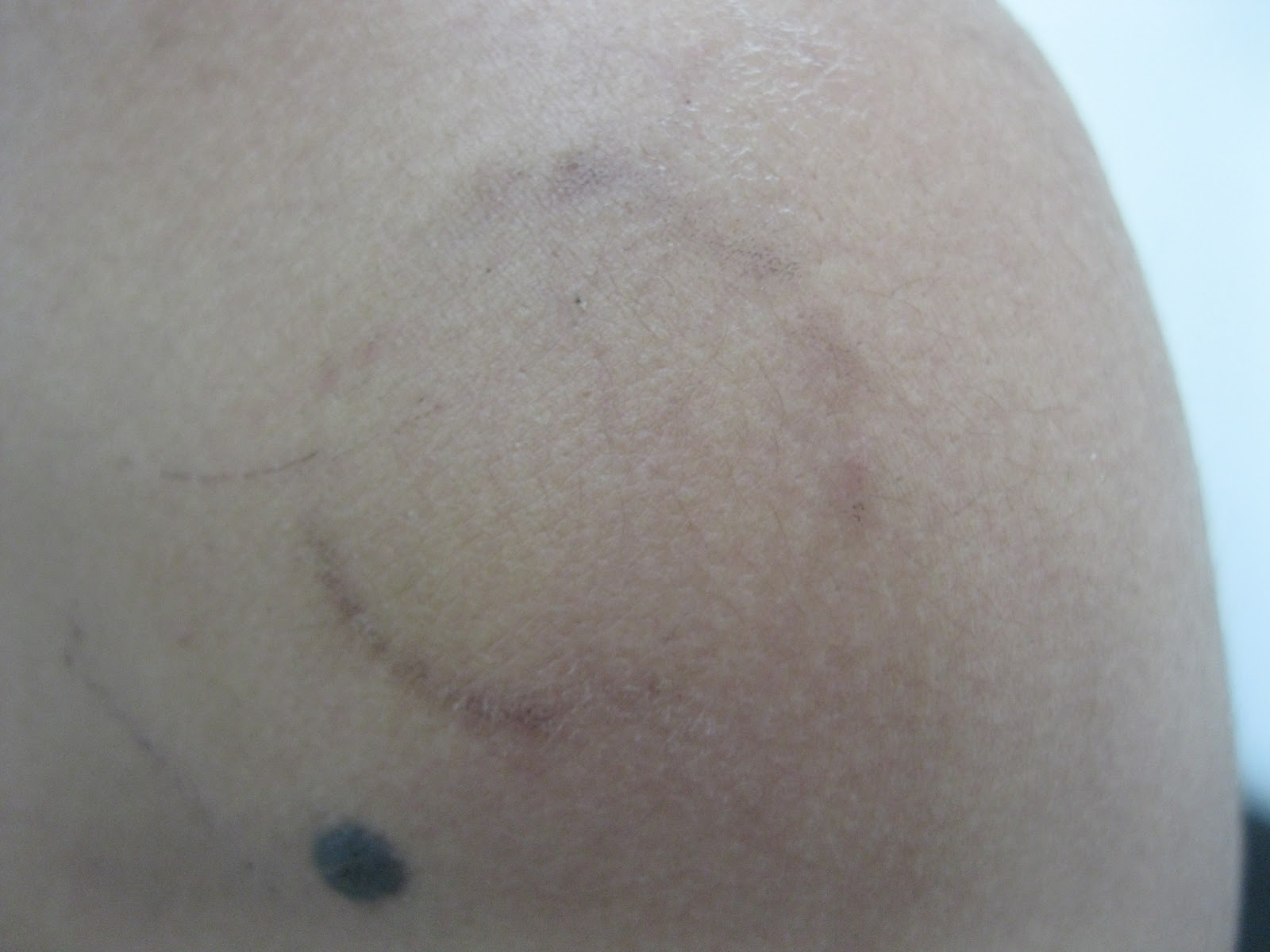 Deformutilation: Postmortem bite marks