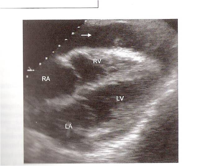 CVT Mohd Farid: Basic Echo Window :Subcostal View