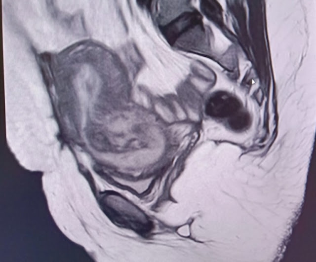 Cesarean scar ectopic pregnancy- MRI - Sumer's Radiology Blog