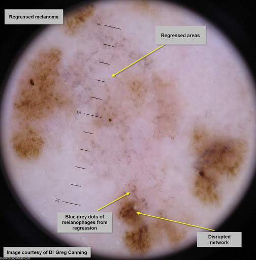 Dermoscopy Features as Clues: Eccentric structureless area any colour ...