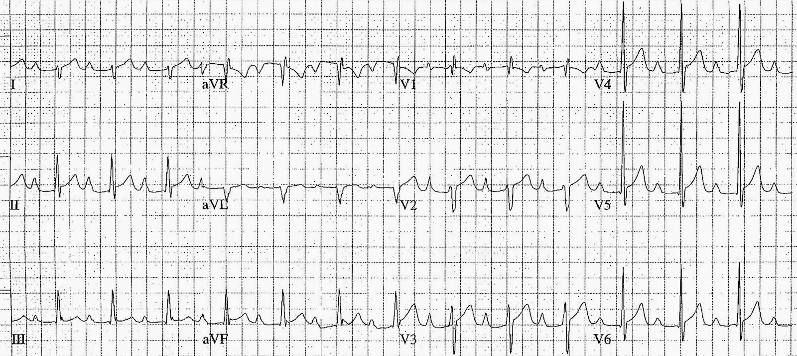 ECG of the Week: ECG of the Week - 17th September 2012 - Interpretation
