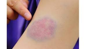 El Padilla se mueve: Lesiones deportivas. Contusiones, esguinces y ...