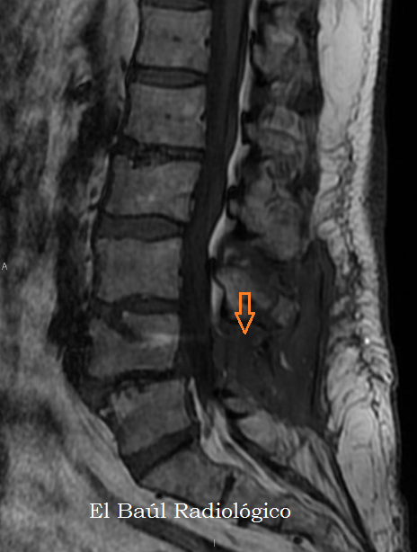 El Baúl Radiológico: SEROMAS POSTQUIRÚRGICOS PARAVERTEBRALES (Lumbar ...