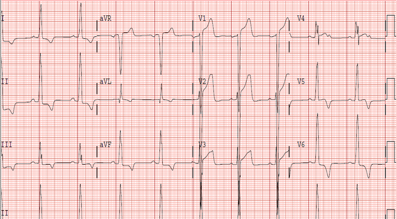 Dr. Smith's ECG Blog: Left Bundle Branch Block with Less Than 1 mm of ...