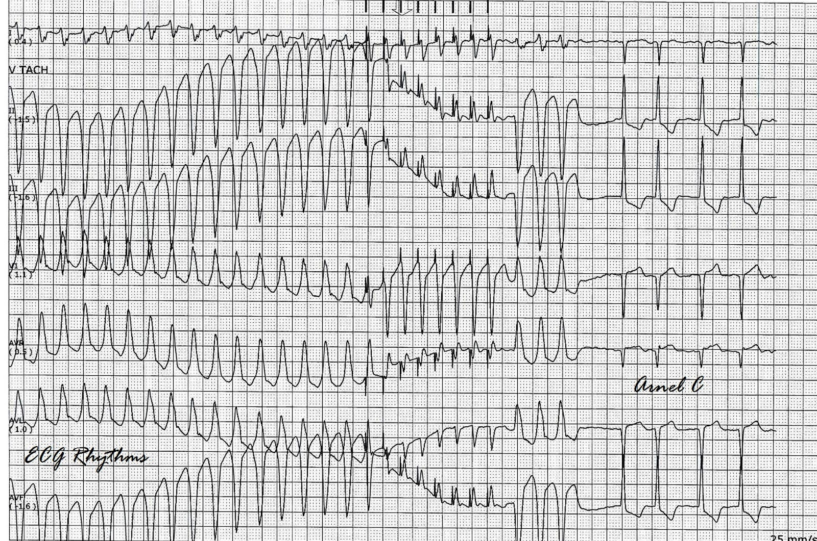 ECG Rhythms: Antitachycardia Pacing