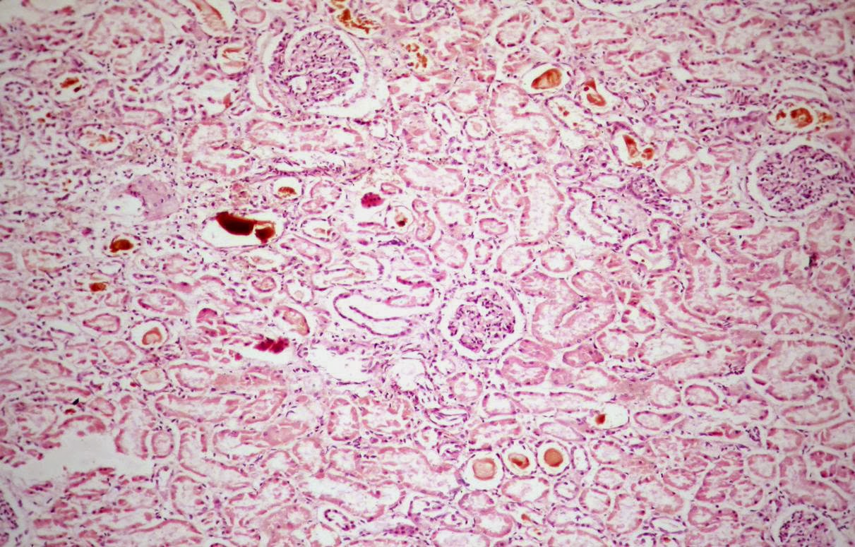 22.Icterus renis. | Pathology